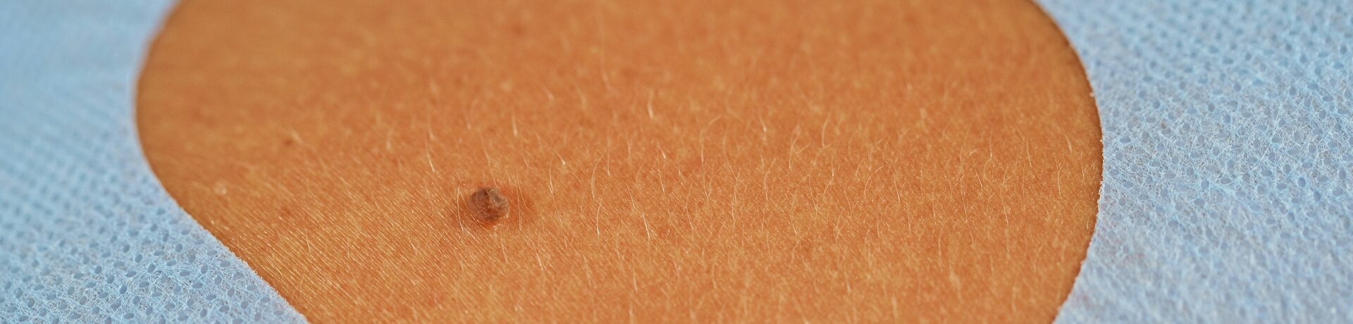 Czerniak złośliwy – objawy, diagnostyka i leczenie | Polisoteka Zdrowie